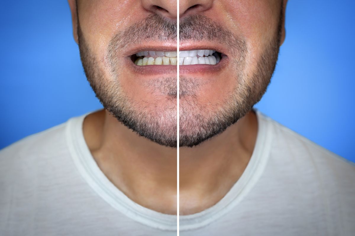 Who Is an Ideal Candidate for Cosmetic Bonding in North Buffalo?